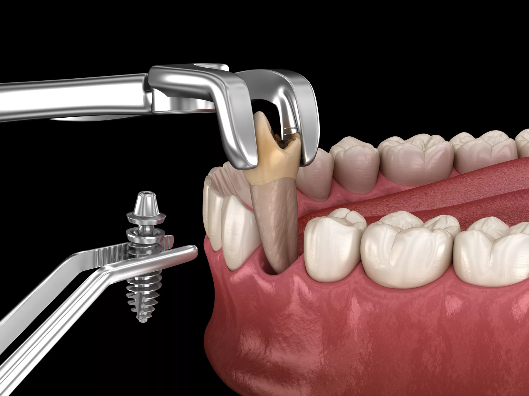Tooth Extractions in Cancun Cosmetic Dentistry - CCD